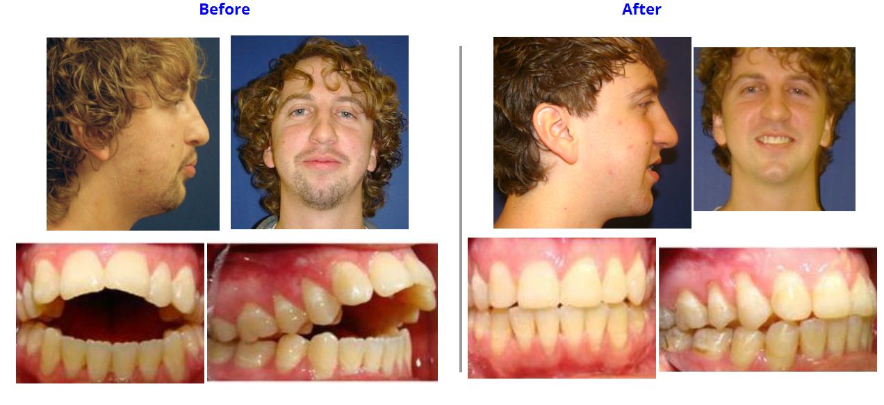 Before After Gallery - Casey Cosmetic Surgery | Facial and Body Surgery