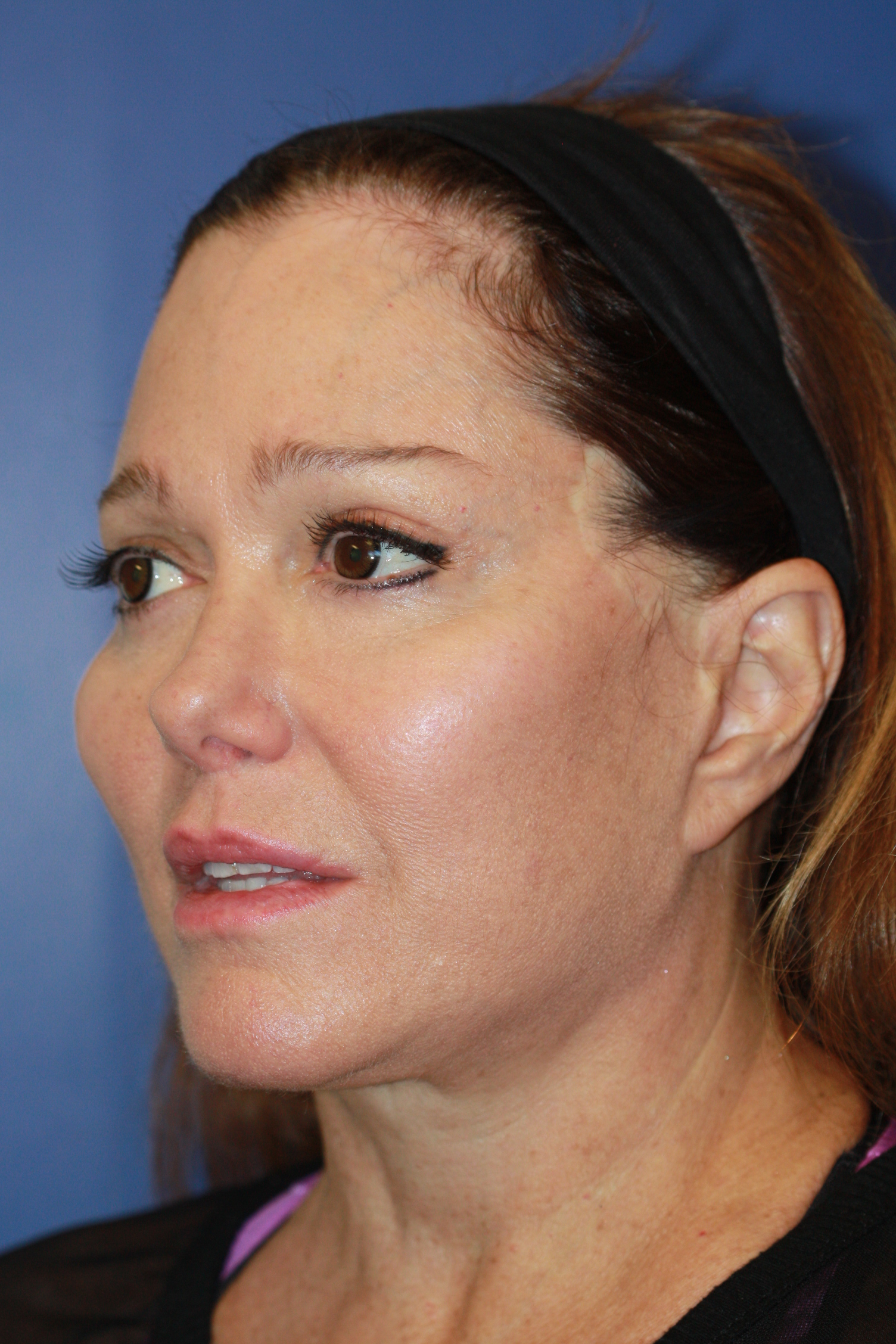 Finazzo, Maria.Facelift.AFTER - Casey Cosmetic Surgery | Facial and ...