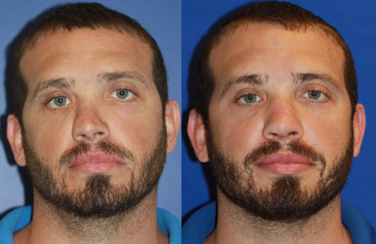 Rhinoplasty or Nasal Surgery by Dr. Gregory Casey