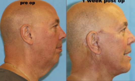 Facelift / Rhytidectomy Surgery | Before and After Photo Gallery