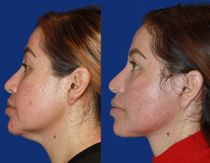 Facelift / Rhytidectomy Surgery | Before and After Photo Gallery